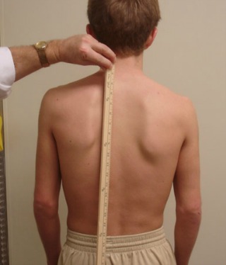 Hruska Clinic : Patient Resources : Is your right shoulder lower than ...