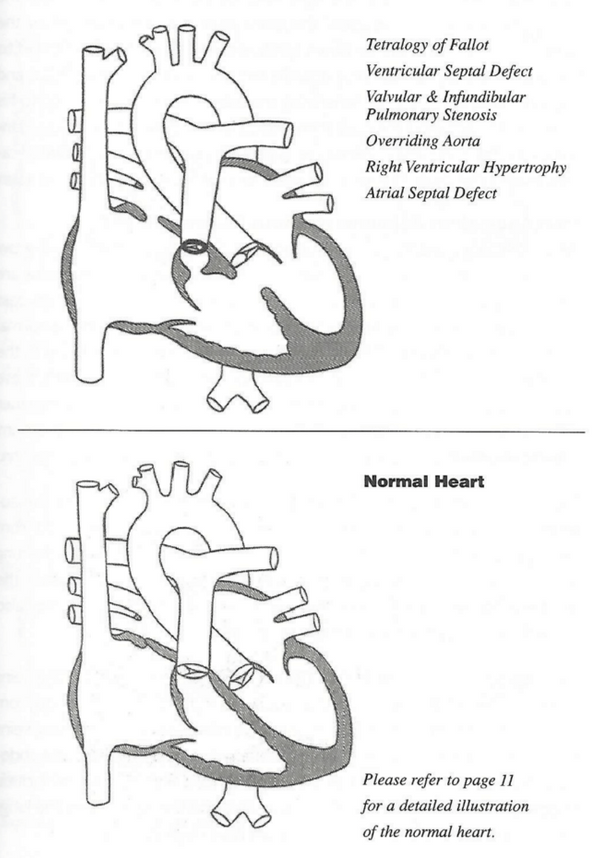 Children’s Heart | About CHDs | Types of CHDs