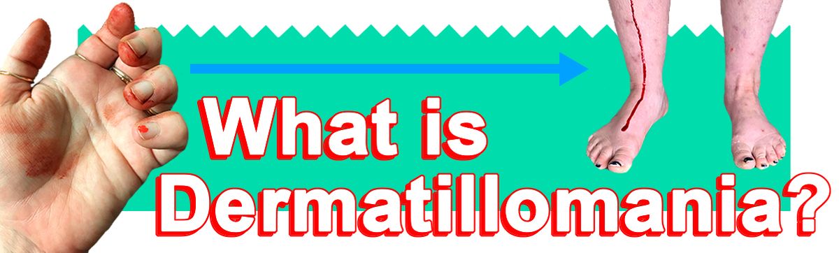 Dermatillomania aka Skin Picking Disorder/ Excoriation/ Excoriation ...
