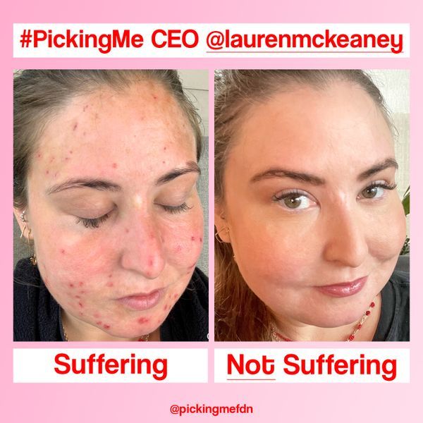 Dermatillomania aka Skin Picking Disorder/ Excoriation/ Excoriation ...