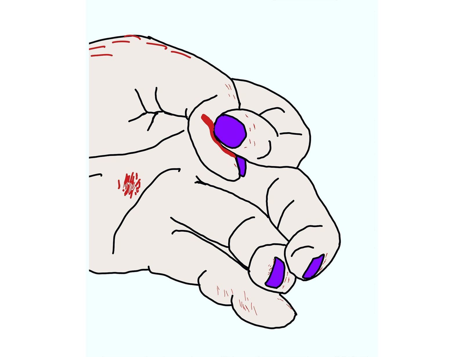 Skin Picking / Dermatillomania Art by Suffers and Supporters of the ...