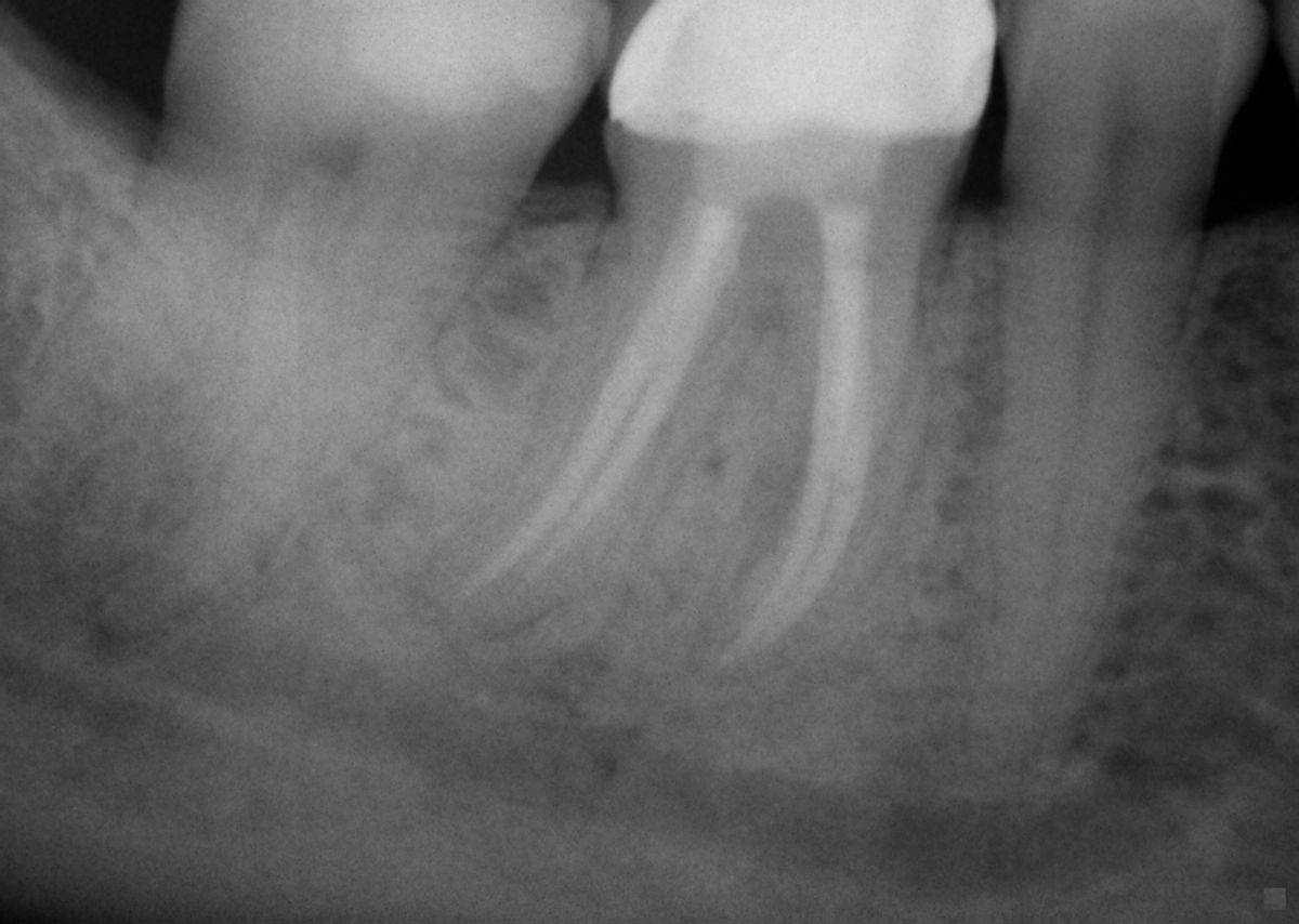 Retreatments : What We Do : Cornerstone Endodontics
