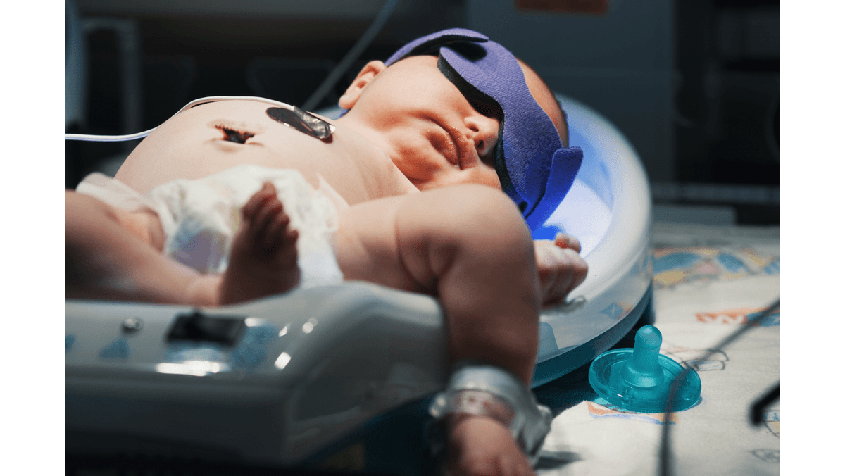 Revised Hyperbilirubinemia Guidelines : Initiatives : Nebraska ...