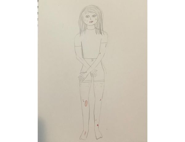 Skin Picking / Dermatillomania Art by Suffers and Supporters of the ...