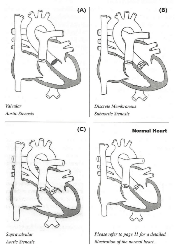Children’s Heart | About CHDs | Types of CHDs
