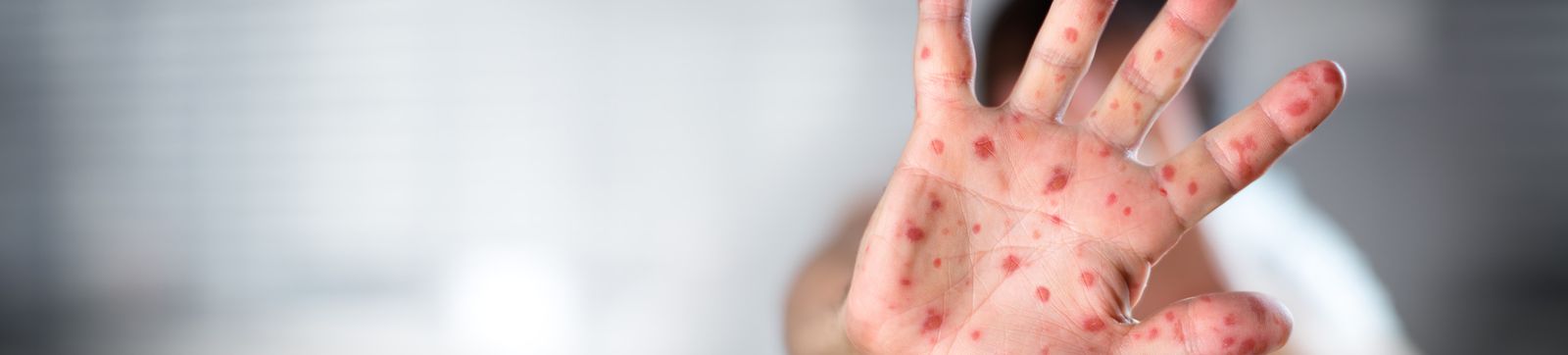 MMR vaccine | Northwest Colorado Health