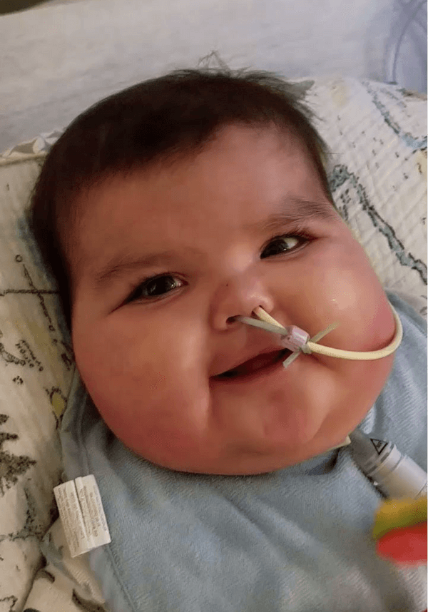 Joshua : Patients & Caregivers : Lymphangiomatosis & Gorham's Disease ...