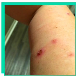 Dermatillomania aka Skin Picking Disorder/ Excoriation/ Excoriation ...