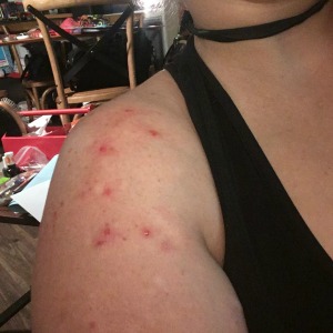 Dermatillomania aka Skin Picking Disorder,Excoriation