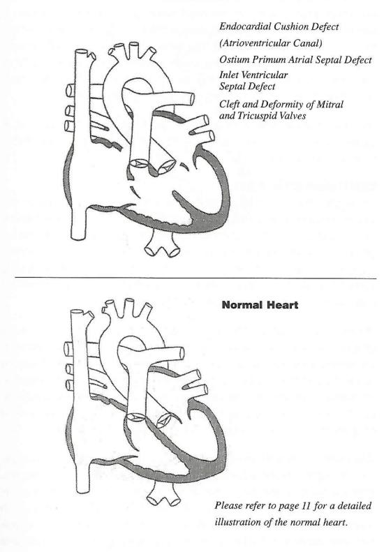 Children’s Heart | About CHDs | Types of CHDs